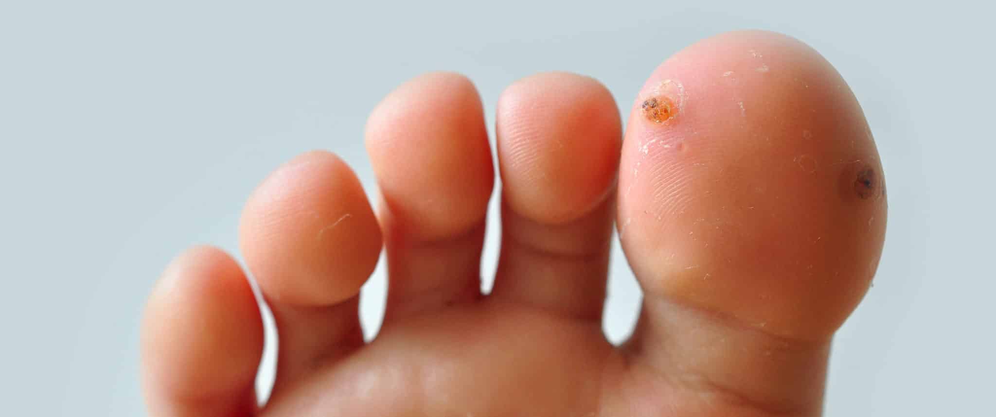 How to prevent & fix your Verruca | Waverley Clinic Farnham