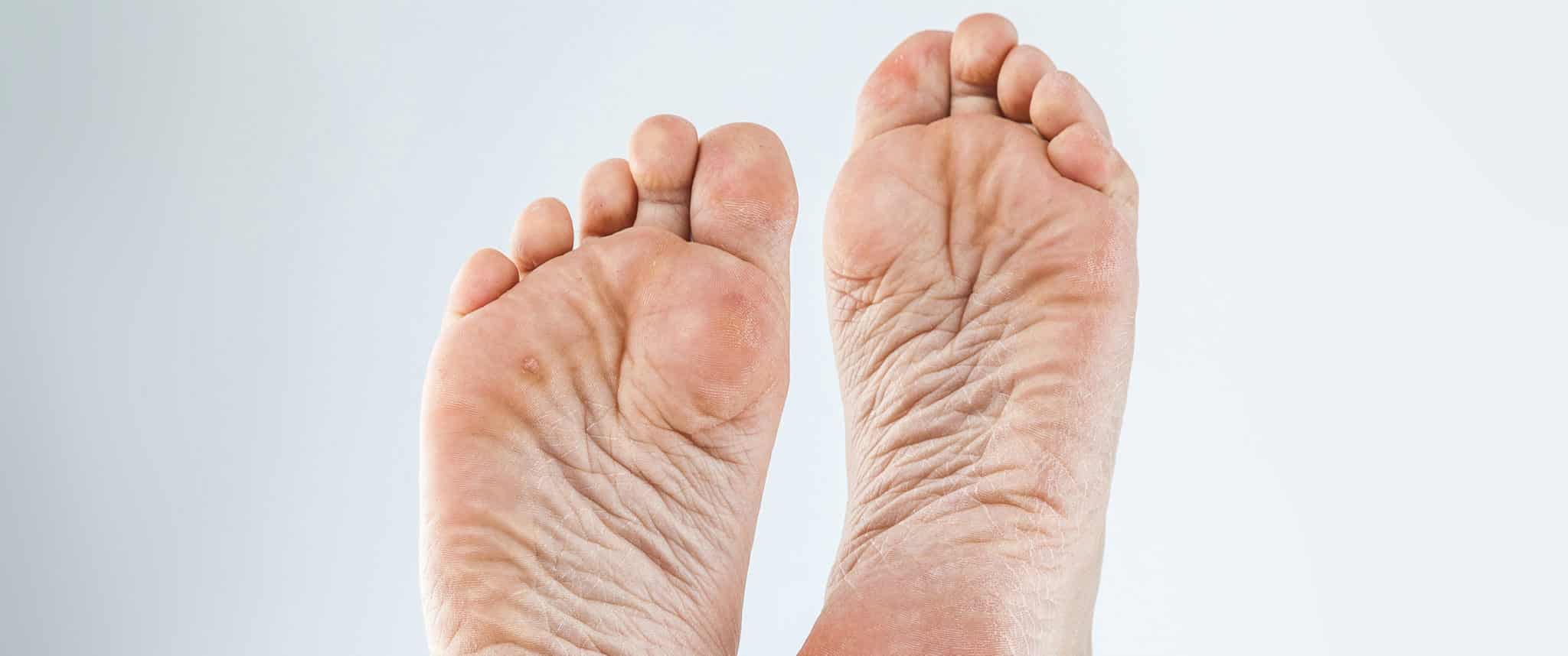 Dry Skin & Cracked Heels - Waverley Clinic