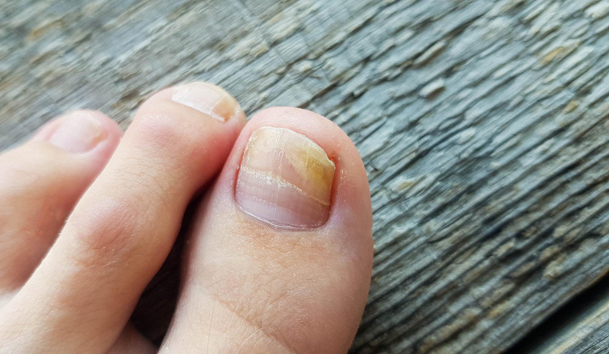 Fungal Nail Infection - Waverley Clinic